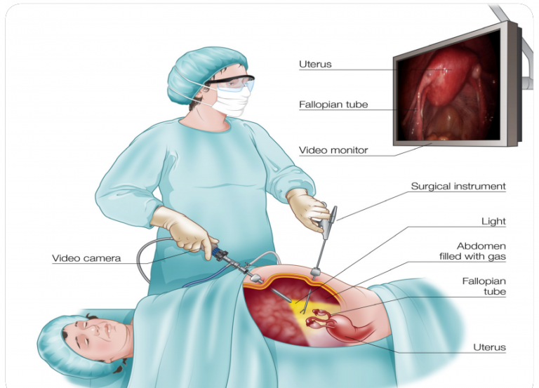Laparoscopy – Rockingham Women's Health Centre