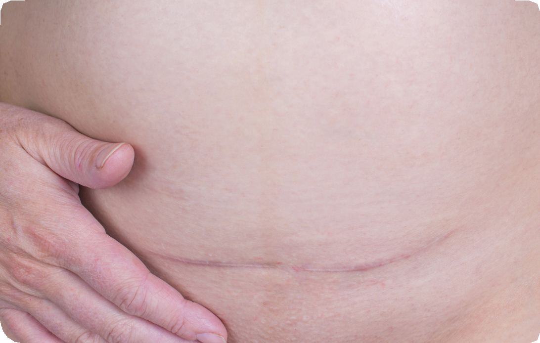 Caesarean section – Rockingham Women's Health Centre